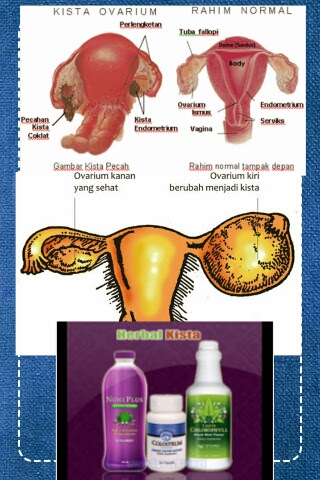 gubuk sehat alami100% organik: Kenali Jenis Kista Ovarium Kista ovarium berupa kantung abnormal ...