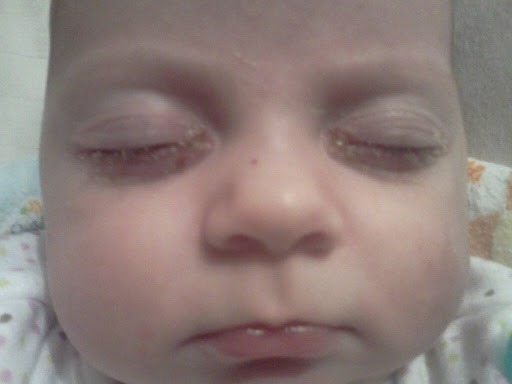 Olivia's Special Heart: Our HLHS Journey: Eyes of goop