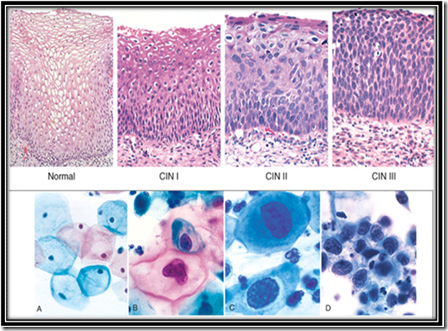 KOLEKSI TUGASAN: PAP SMEAR