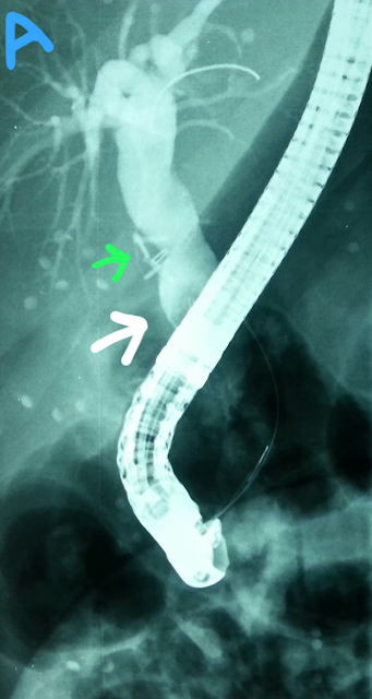 ERCP & EGD : Post cholecystectomy remnant CBD stones