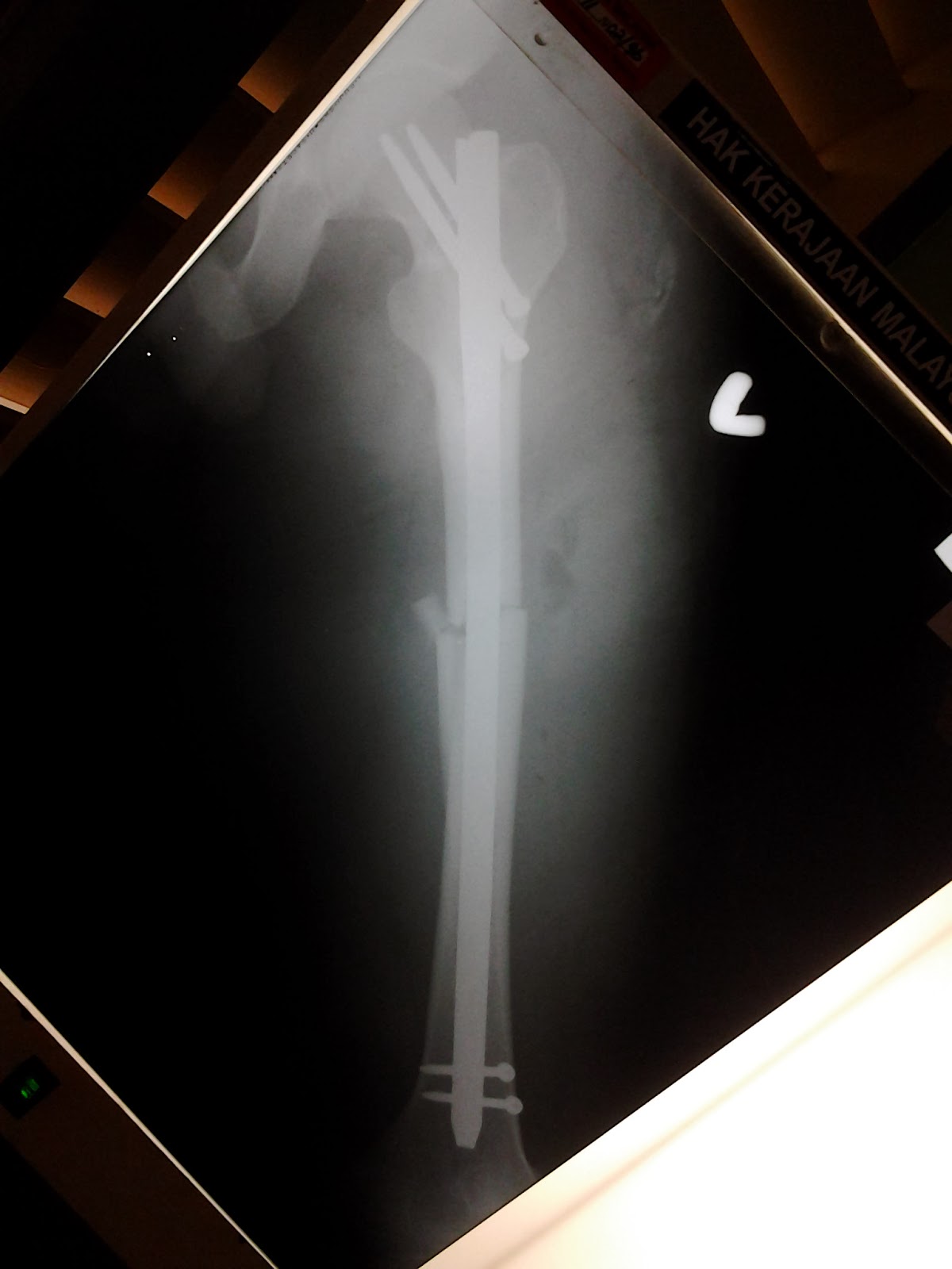 Dr Syukran: Closed proximal 3rd left femur fracture