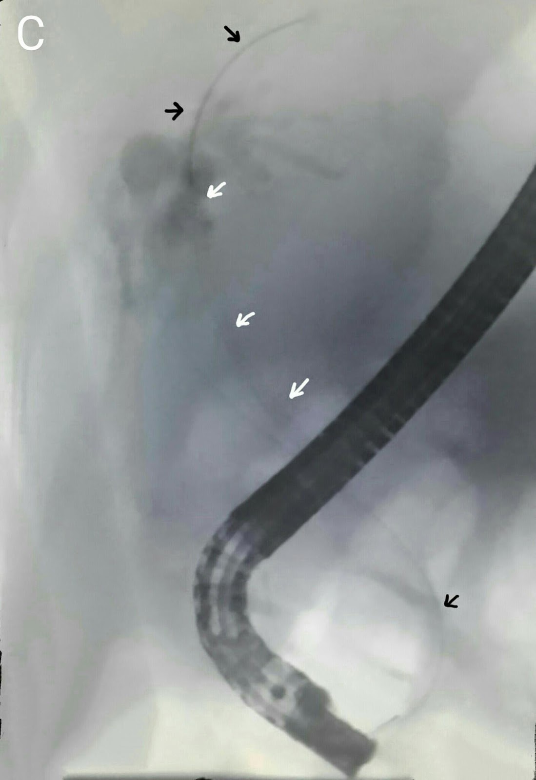 ERCP & EGD : Migrated biliary stent