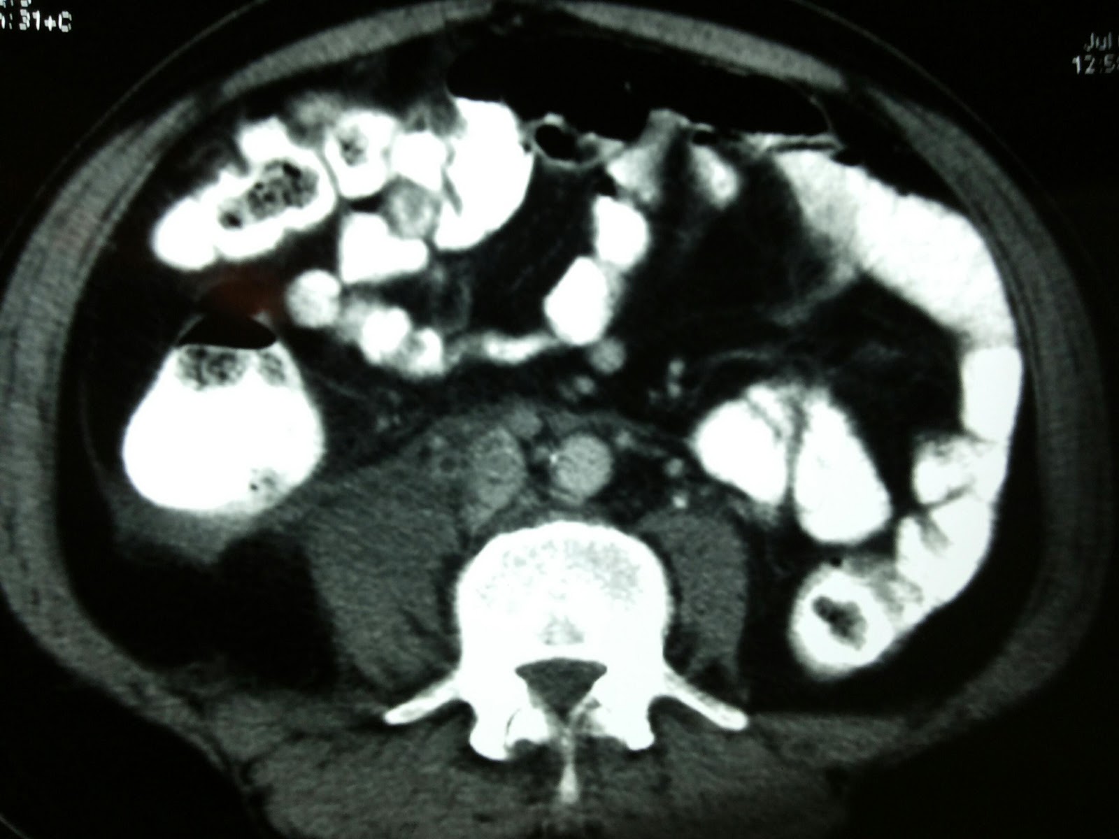 RADIOLOGY IMAGE SPOTTERS: Urinoma ct kub