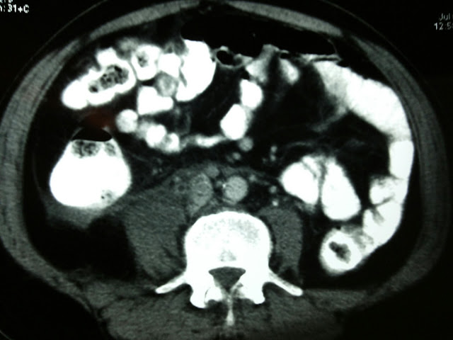RADIOLOGY IMAGE SPOTTERS: Urinoma ct kub