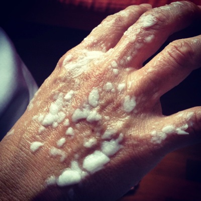 Mini Liew: What to Do When You Burn Your Hand