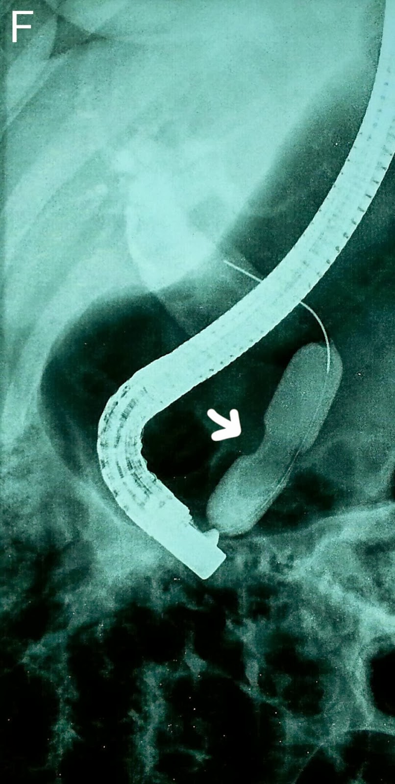 ERCP & EGD : A balloon for every stone