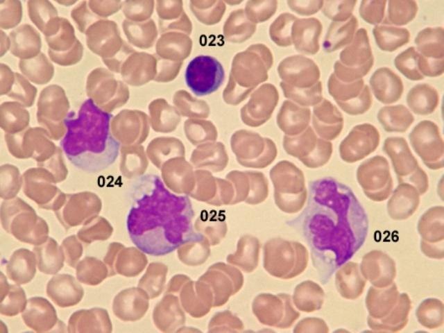 Como identificar linfócitos atípicos | Biomedicina Padrão