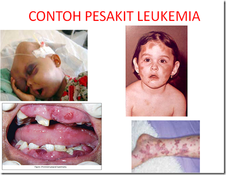KOLEKSI TUGASAN: PENYAKIT LEUKEMIA