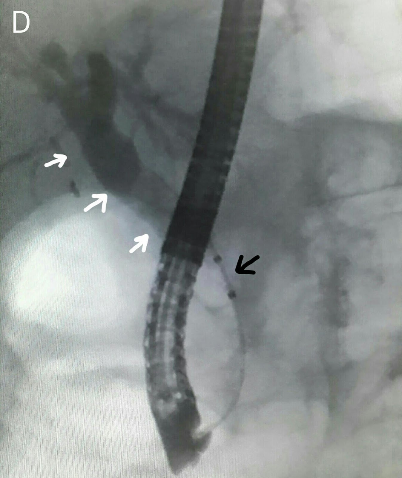 ERCP & EGD : Follow up case of post cholecystectomy biliary leak