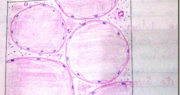 Histology Slides Database: Colloid Goiter – histopathology diagram