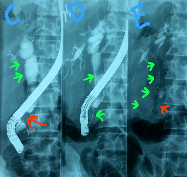ERCP & EGD : Metastatic ampullary tumor