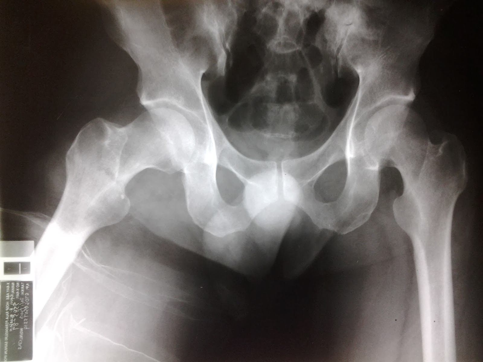 Dr Syukran: Closed proximal 3rd left femur fracture