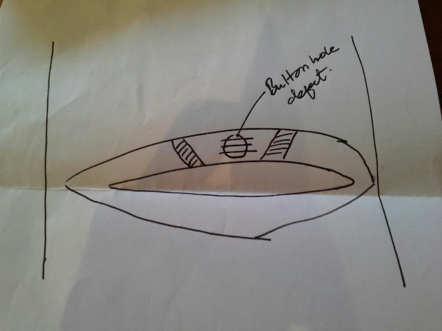 Obstetric experiences: Button hole defects of posterior rectus sheath ...