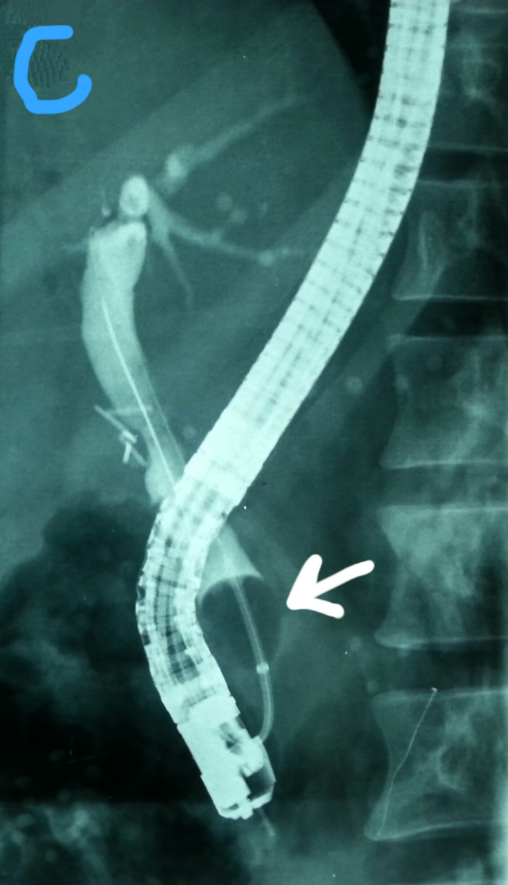 ERCP & EGD : Post cholecystectomy remnant CBD stones