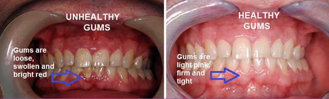 Healthy Gums Colour