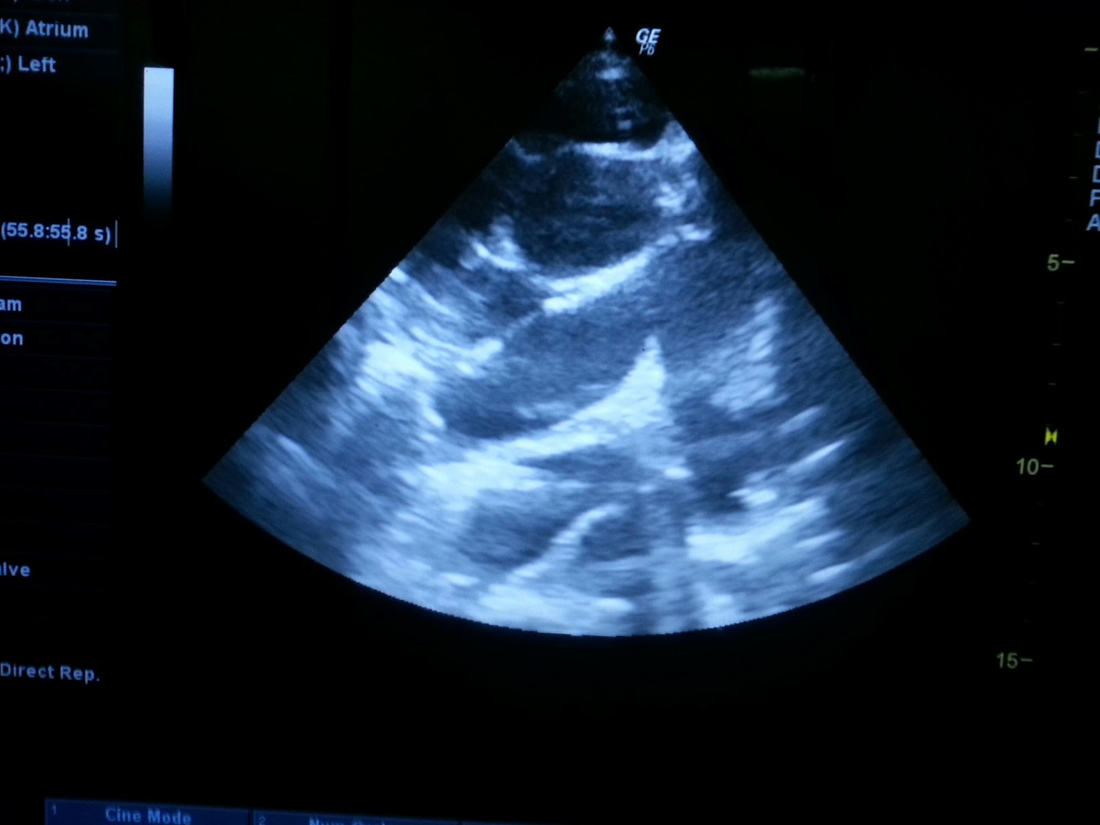 NEELZ ON WHEELZ: COR PULMONALE .dilated RA RV, pulmonary regurgitation ...
