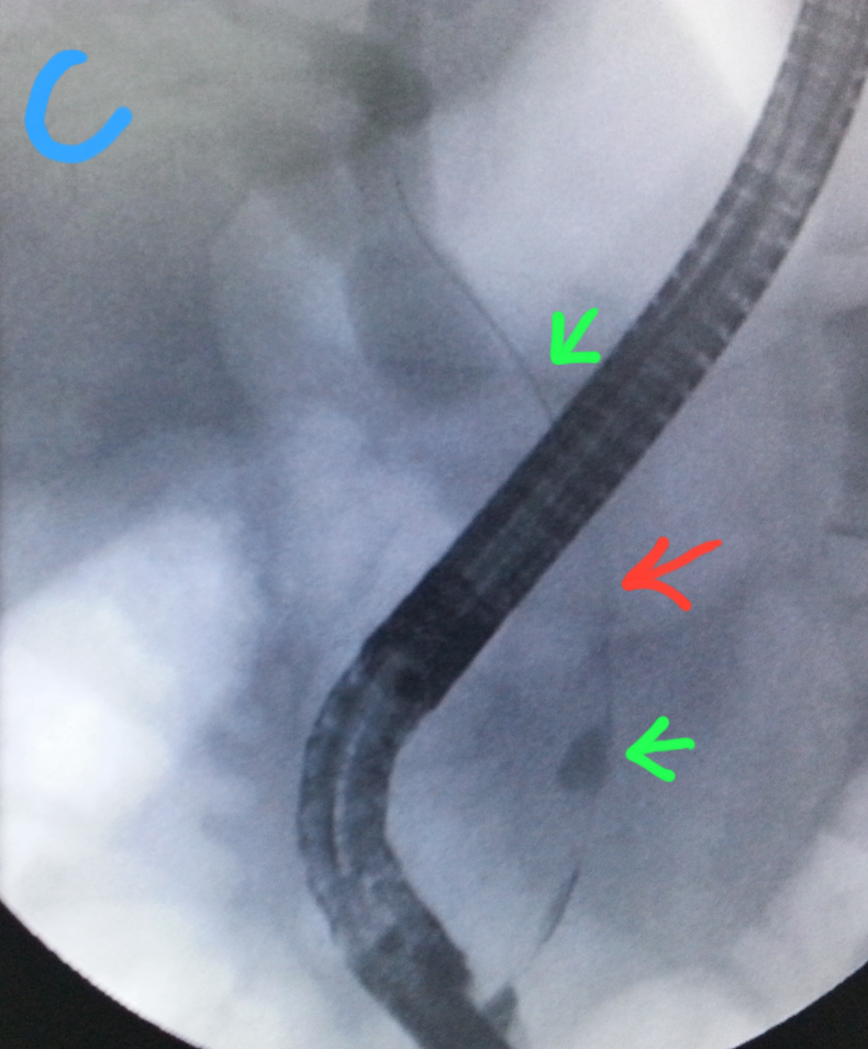 ERCP & EGD : Distal CBD stricture