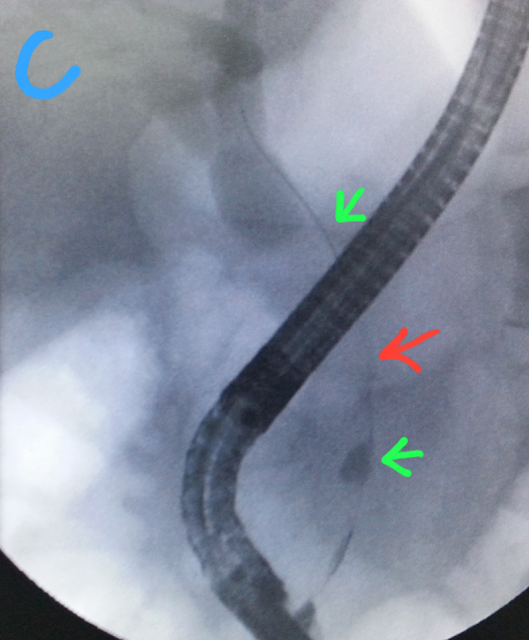 ERCP & EGD : Distal CBD stricture