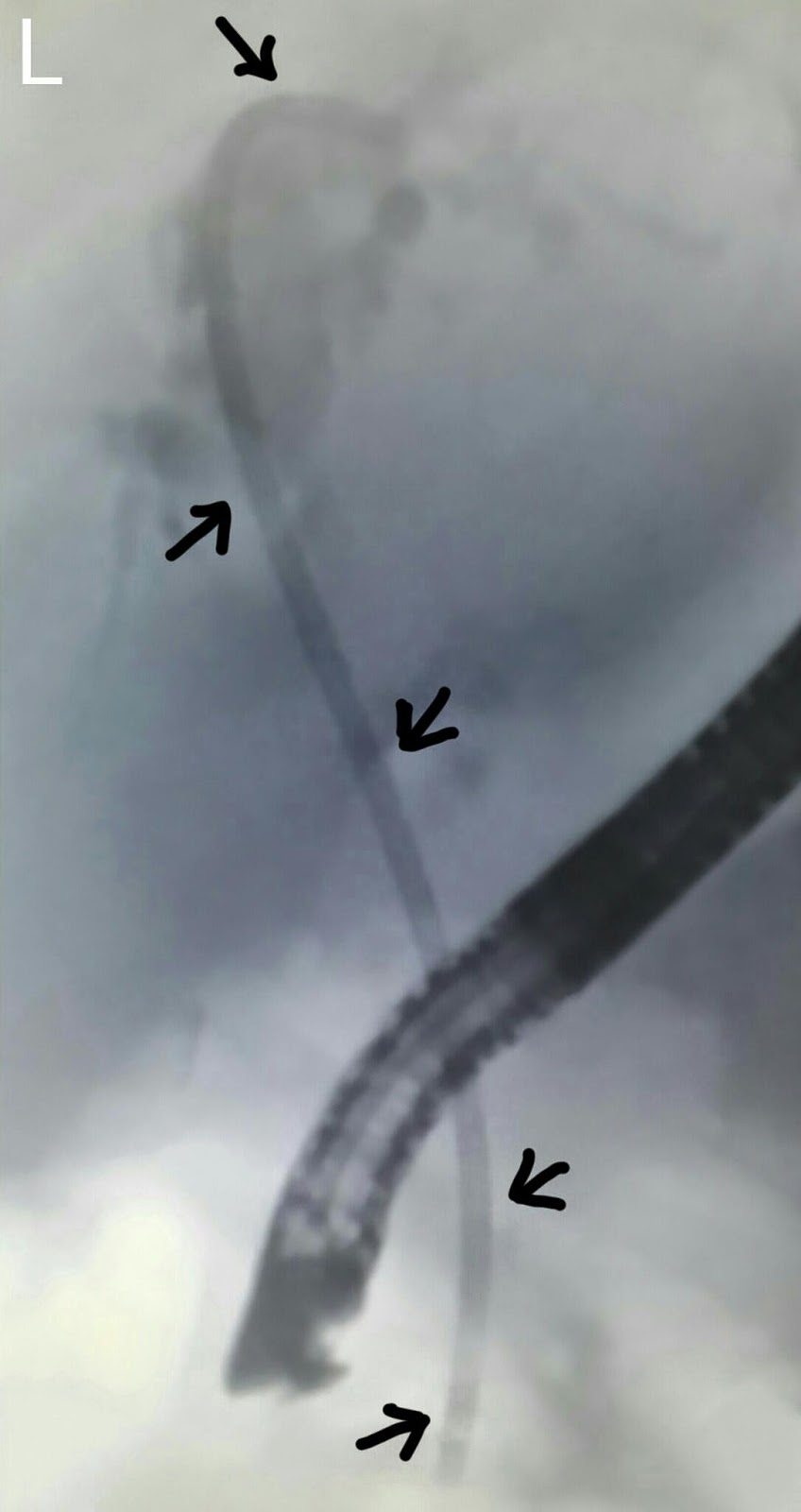 ERCP & EGD : Migrated biliary stent