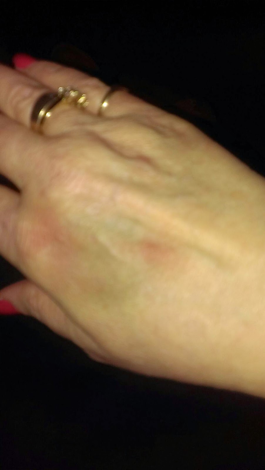 Dermatomyositis: Bruising and Swelling