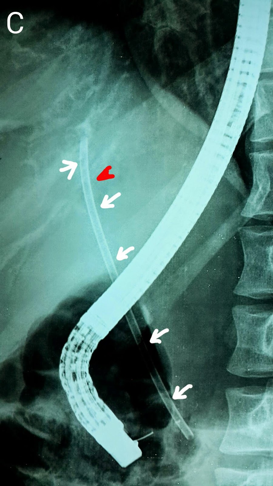 ERCP & EGD : Fifth follow up ERCP for post cholecystectomy biliary ...