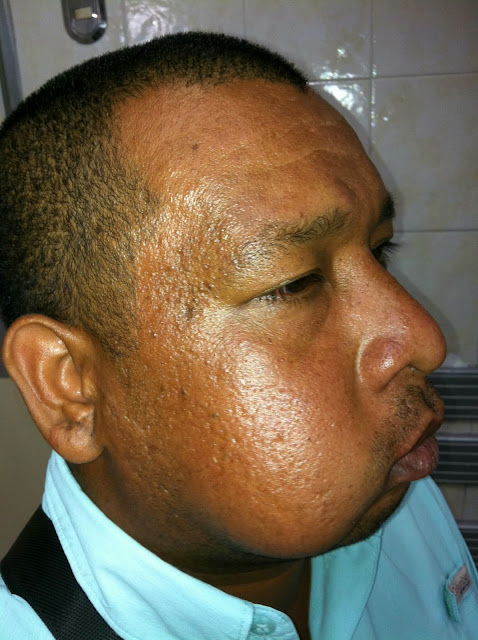 Cohen Cirugia Buco Maxilofacial: Mixoma odontogenico con abordaje weber ...