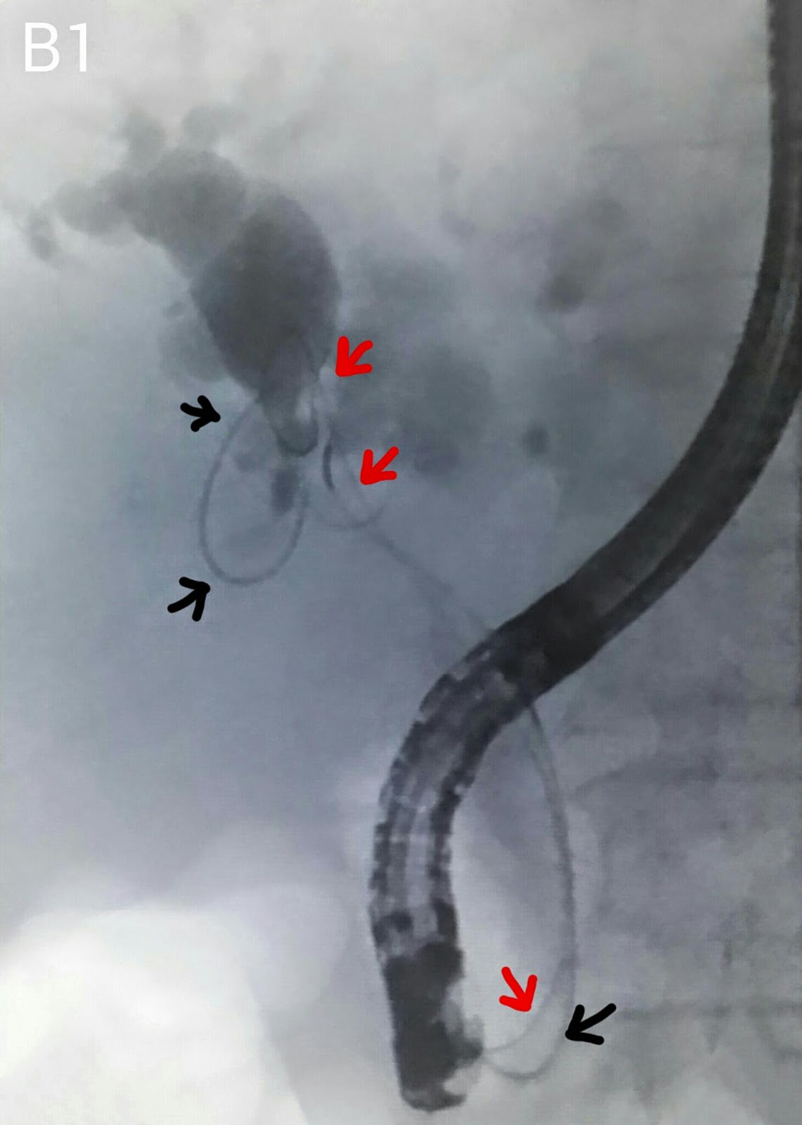 ERCP & EGD : Managing a hilar stricture (or trying to, at least)