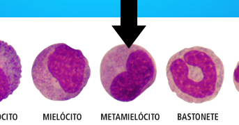 Como identificar metamielócitos na distensão sanguínea | Biomedicina Padrão