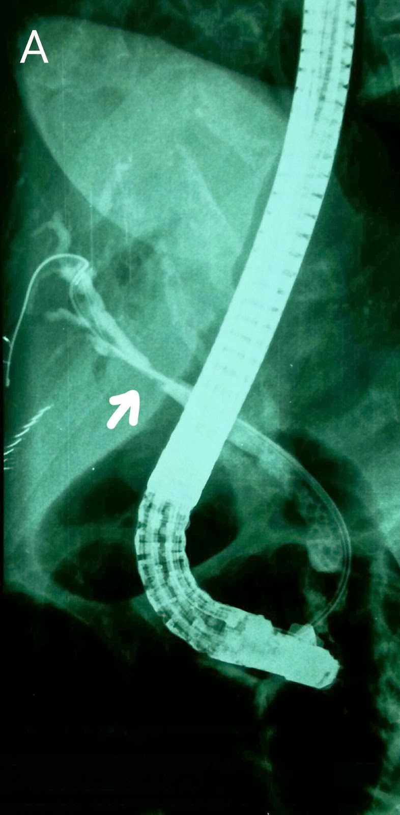 ERCP & EGD : Fourth follow up ERCP for a post cholecystectomy CBD stricture