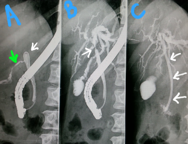 ERCP & EGD : Cholangiocarcinoma and cholangitis