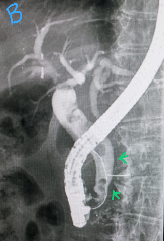 ERCP & EGD : Choledocholithiasis and cholelithiasis