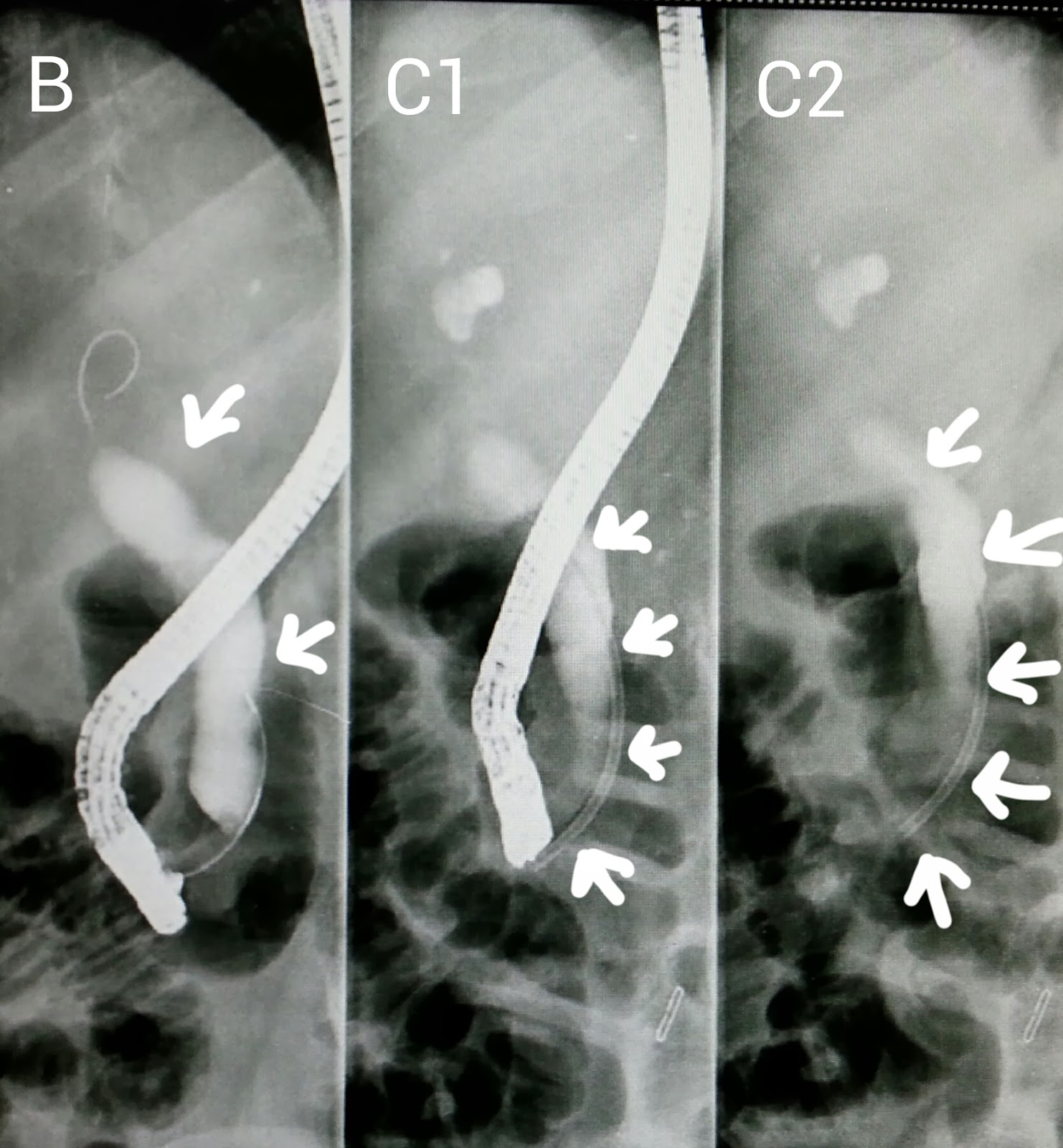 ERCP & EGD : Metastatic ampullary carcinoma