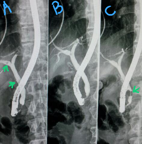 ERCP & EGD : Bile duct stones in a patient due to undergo cholecystectomy
