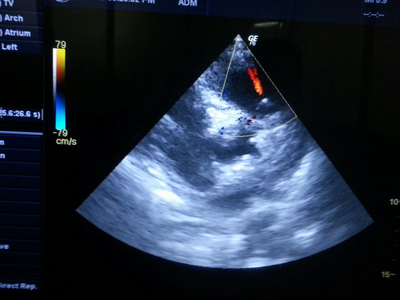 NEELZ ON WHEELZ: COR PULMONALE .dilated RA RV, pulmonary regurgitation ...