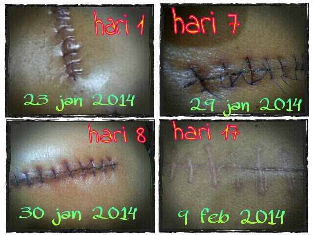 What's Up Izang!: Kesan parut pembedahan lepas buang batu karang dalam ...