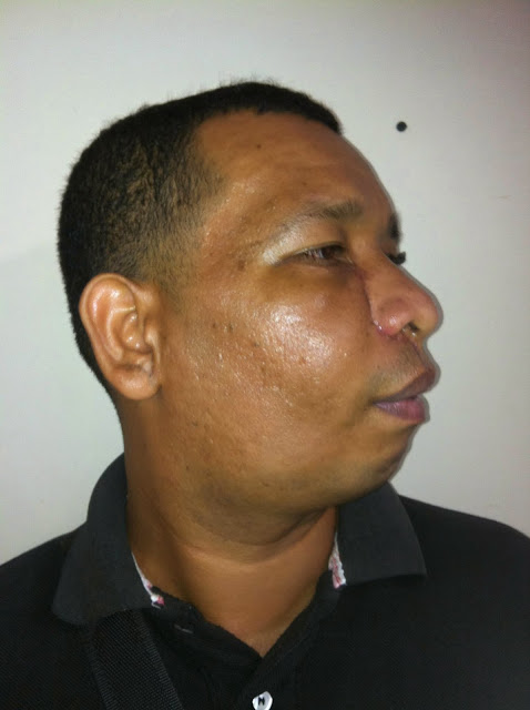 Cohen Cirugia Buco Maxilofacial: Mixoma odontogenico con abordaje weber ...