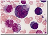 KOLEKSI TUGASAN: LEUKEMIA