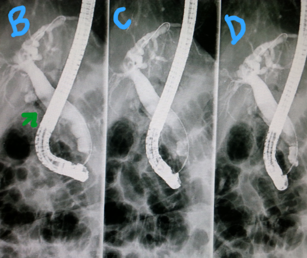 ERCP & EGD : Bile duct clearance with an intra-diverticular ampulla