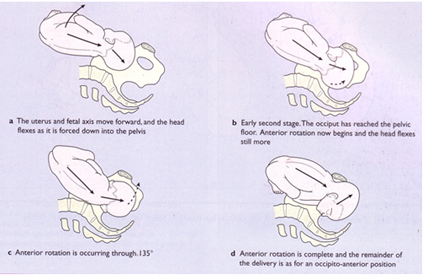 INFORMASI REPRODUKSI: POSISIO OKSIPITALIS POSTERIOR PERSISTEN