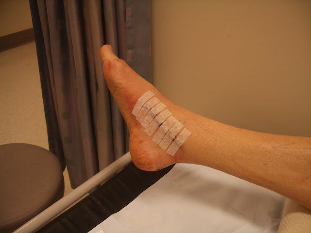 Documenting My Posterior Tibial Tendon Surgery and Recovery: Stitches ...