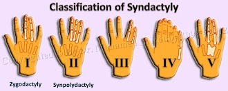 "TODO SOBRE SINDACTILIA"