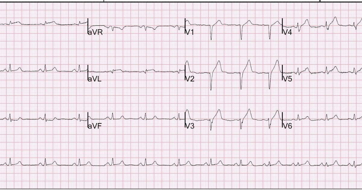Dr. Smith's ECG Blog: Subtle ST elevation in acute LAD occlusion ...