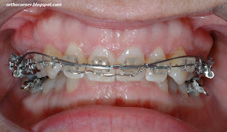 Orthodontic Corner: Class II div 2 Deep Bite, Where is the Limit