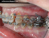 Orthodontic Corner: Class II div 2 Deep Bite, Where is the Limit