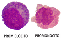 Leucemia Mielóide Aguda (LMA) | Biomedicina Padrão