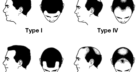 Balding Celebrities: About the Hamilton-Norwood scale