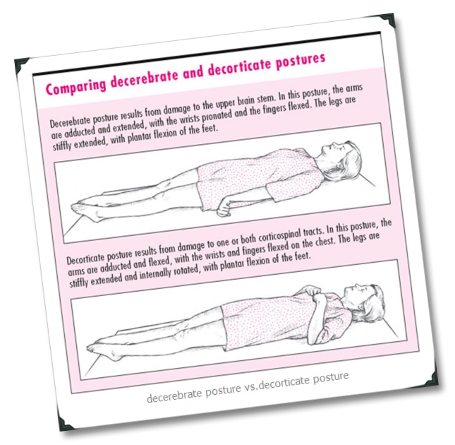 aayusha: Decerebrate posture/Decerebrate rigidity/Abnormal extensor reflex