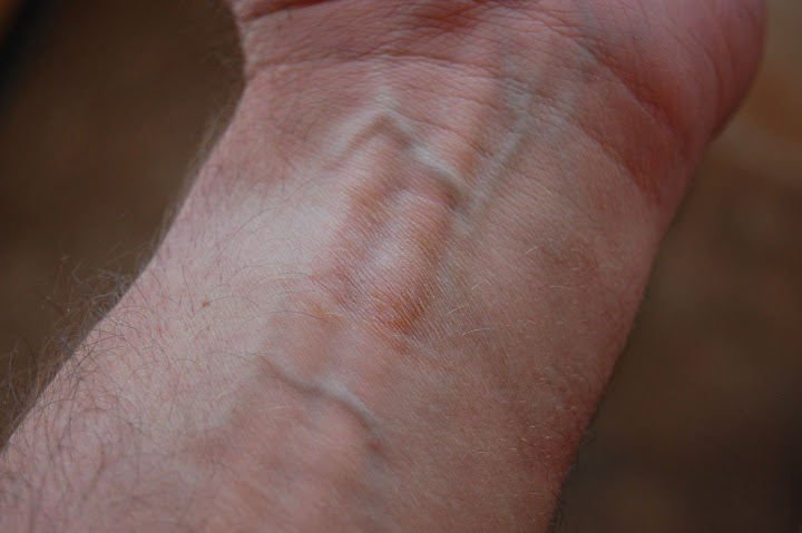 Nickel allergy | WatchUSeek Watch Forums